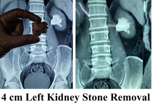 A Large 40 mm (4 cm) Left Kidney Stone Removal By Dr. Suraj Lunavat